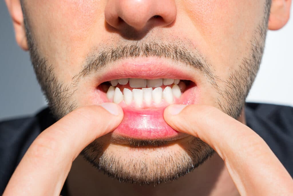 Types of Crooked Teeth - Ricci Orthodontics